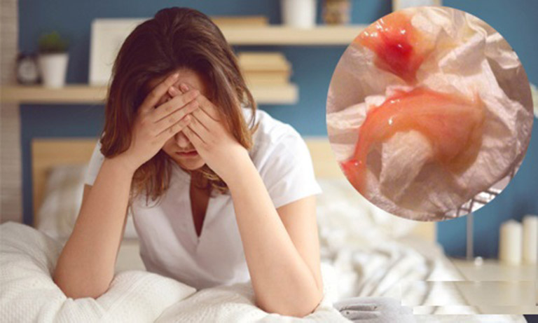 Khí hư kèm sợi máu: Nguyên nhân và cách chữa hiệu quả